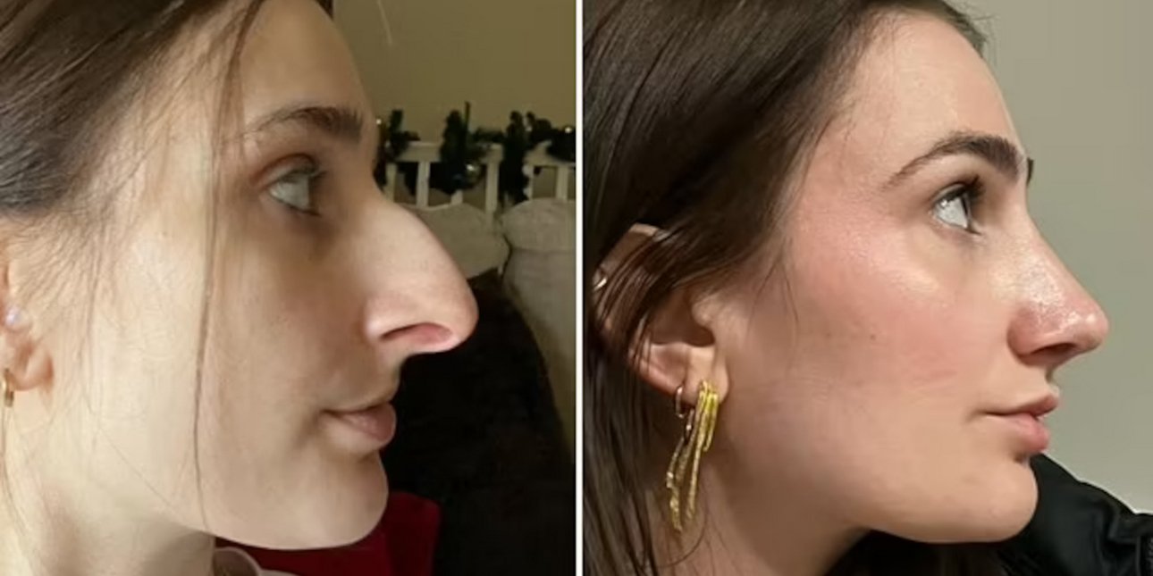 30χρονη μοιράστηκε στο TikTok πώς η πλαστική στη μύτη άλλαξε τη ζωή της ...