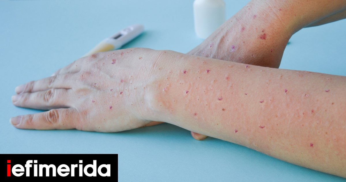 Φιλιππίνες: Εντοπίστηκε το πρώτο κρούσμα της ευλογιάς των πιθήκων ...
