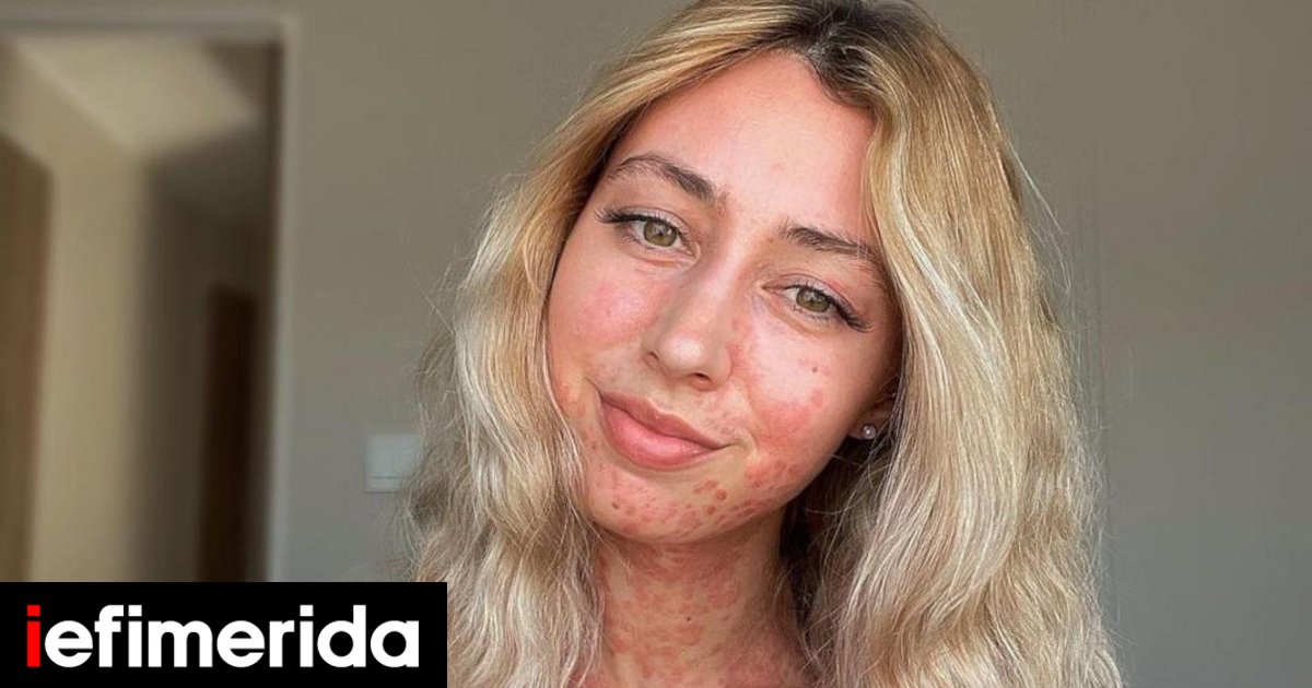 25χρονη influencer εξηγεί πώς είναι να ζει κανείς με ψωρίαση -Στέλνει ...