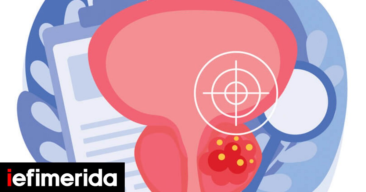 Αιματουρία και καρκίνος ουροδόχου κύστης - iefimerida.gr