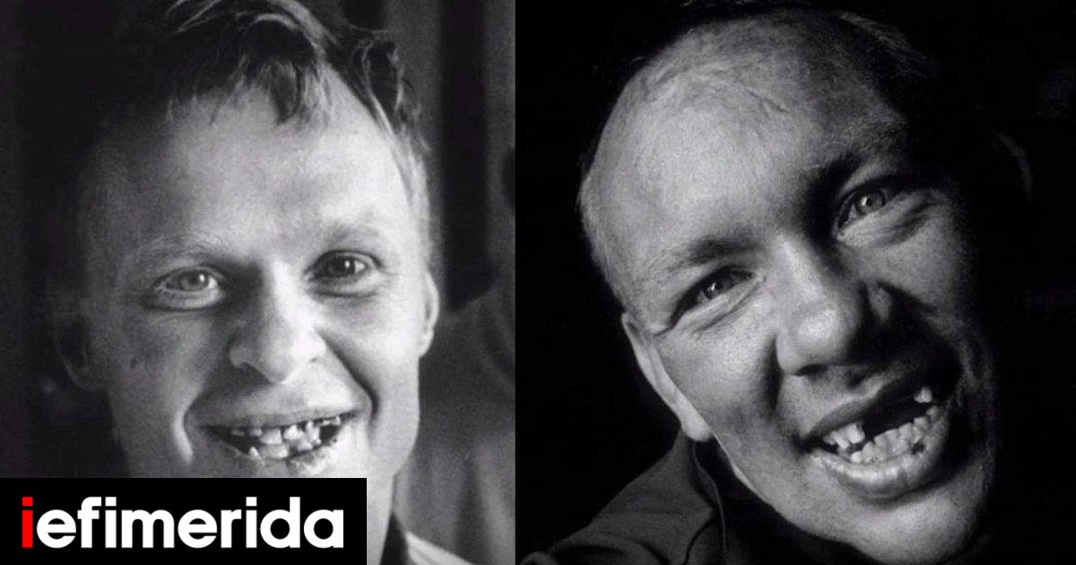 The Vipeholm Experiments: Τα φρικτά οδοντιατρικά πειράματα της Σουηδίας ...