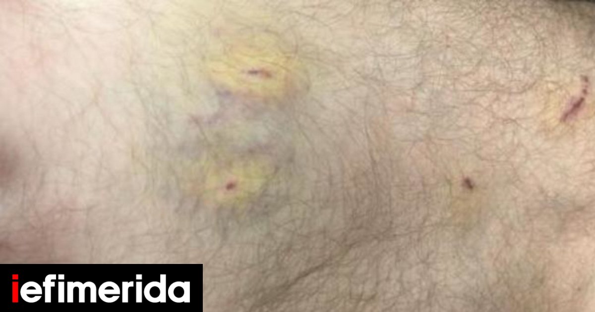 Φωτογραφίες ντοκουμέντα: Τα σημάδια από τα βασανιστήρια των απαγωγέων ...