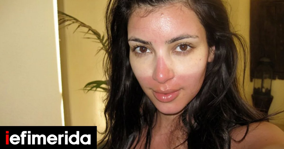 Μείνατε πολλή ώρα στον ήλιο και πάθατε έγκαυμα; Να πώς θα το κρύψετε και θα απαλλαγείτε γρήγορα ...